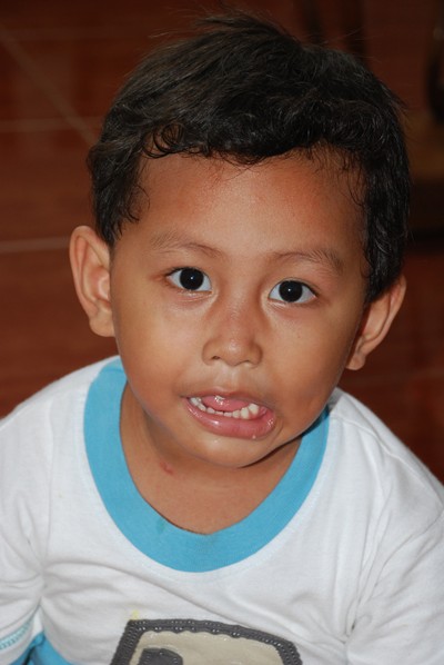 KARIES RAMPAN ATAU GIGIS